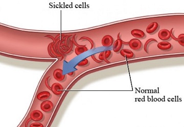 Sickle Cell Disease | Just-Health.net
