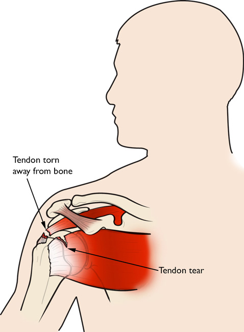 Signs and Test to Tell a Torn Rotator Cuff | Just-Health.net